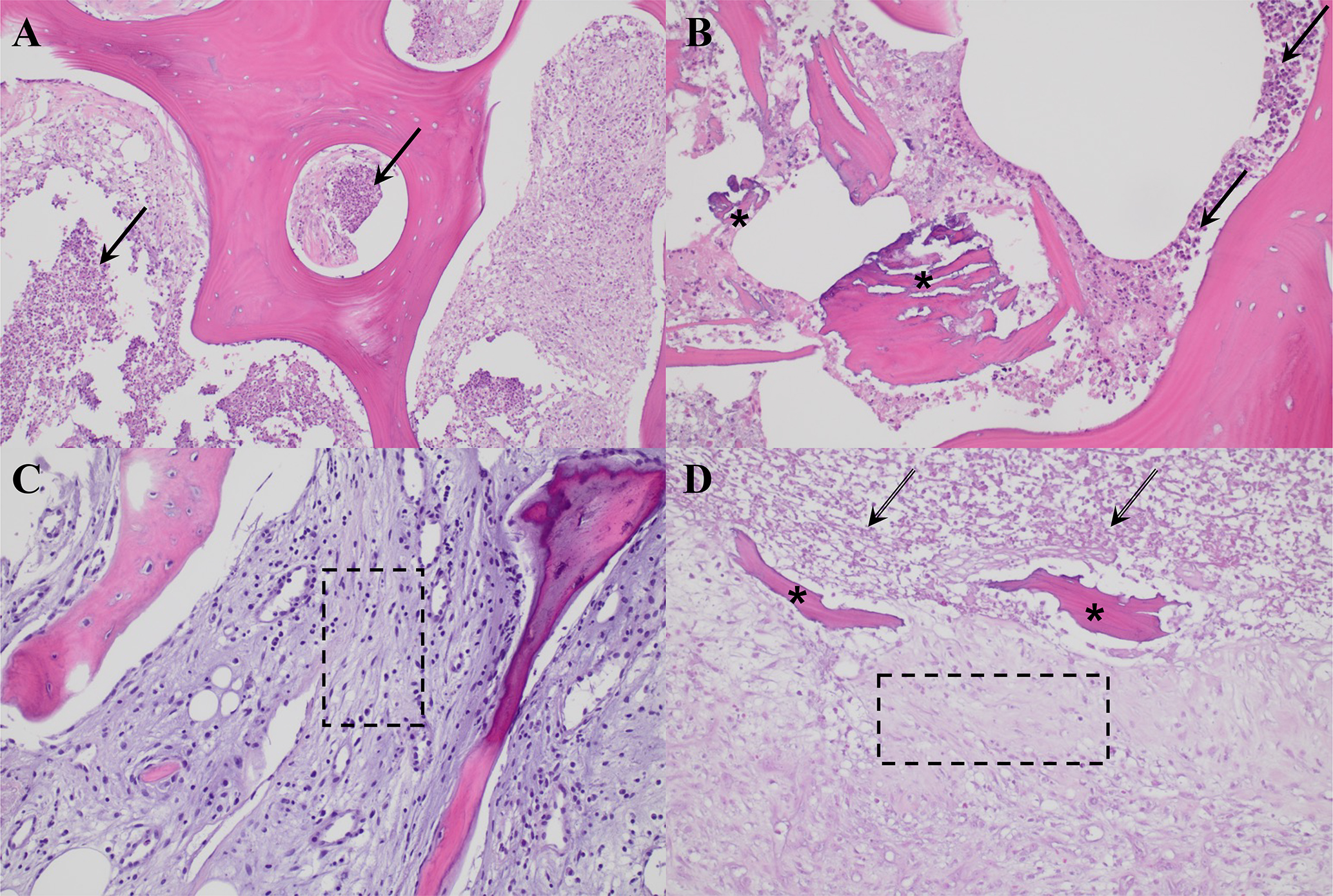 JBJI - Osteomyelitis in peri-implant bone of hip prosthetic joint ...